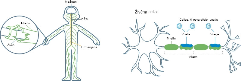 Kaj je multipla skleroza?